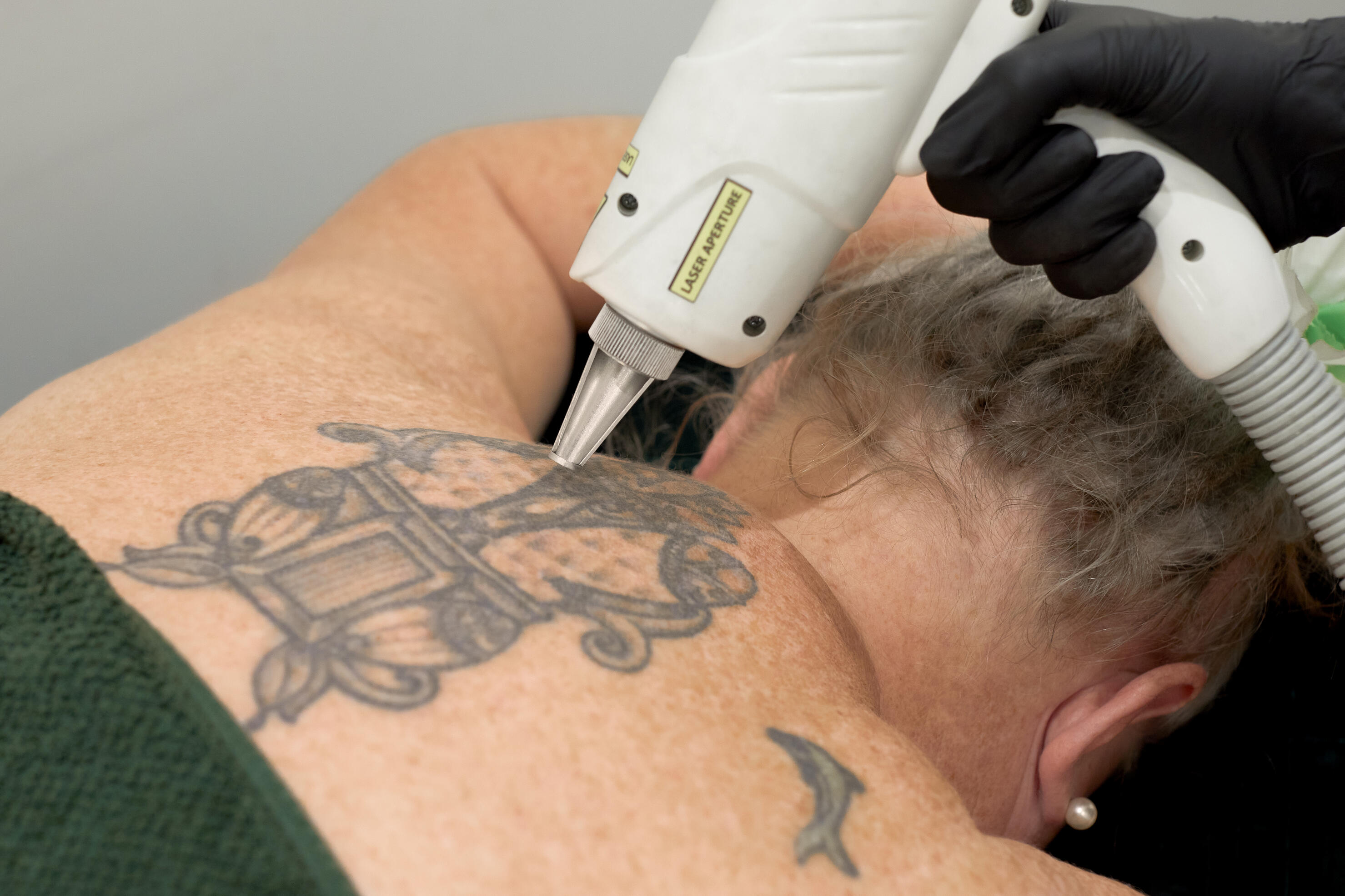 Tattoo Removal | The Salon, Skin and Laser Clinic, Essex